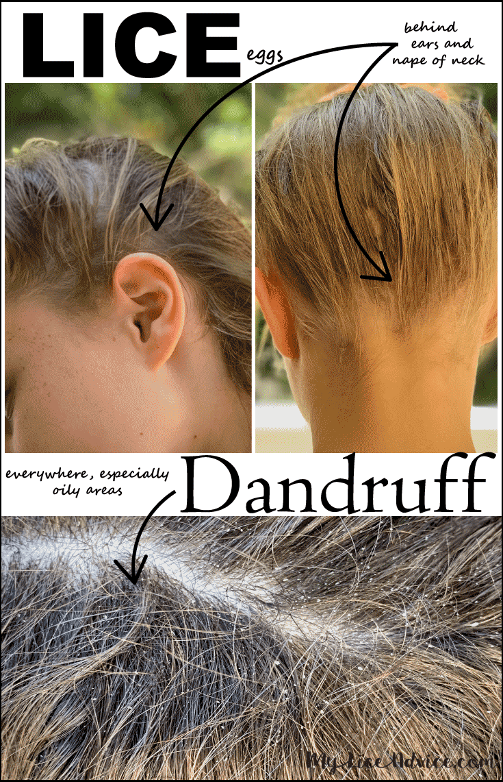 What S The Difference Between Dandruff And Lice Eggs In Hair In Hindi