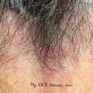 A Closer Look at Lice Bites and Rashes with Pictures - My Lice Advice