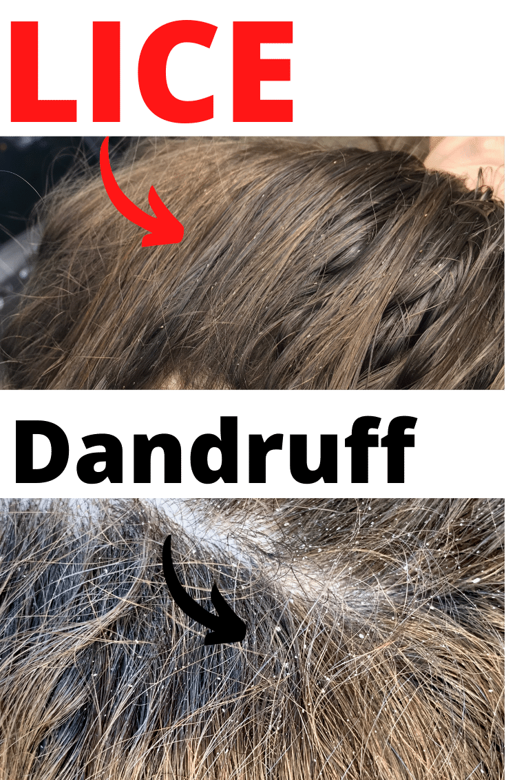 How Do You Tell The Difference Between Dandruff And Lice Eggs ... How Do You Tell The Difference Between Dandruff And Lice Eggs ...