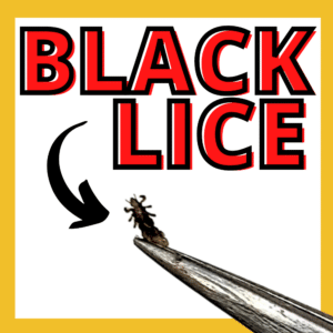 Black Lice and Lice in Black Hair (with Pictures) - My Lice Advice